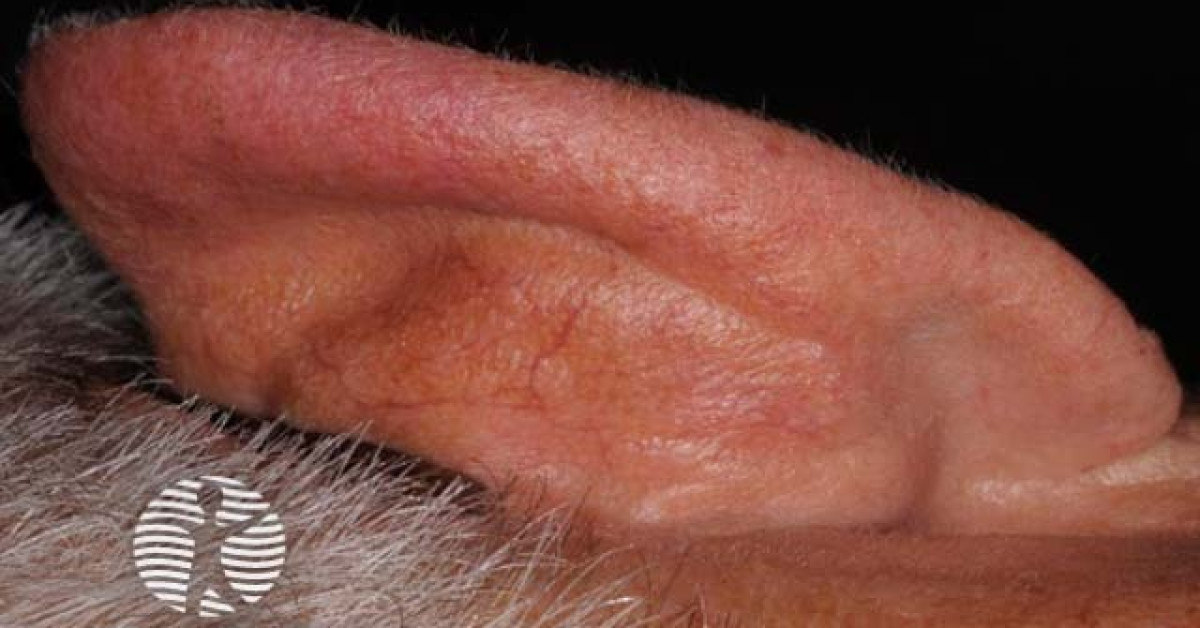 Relapsing polychondritis image