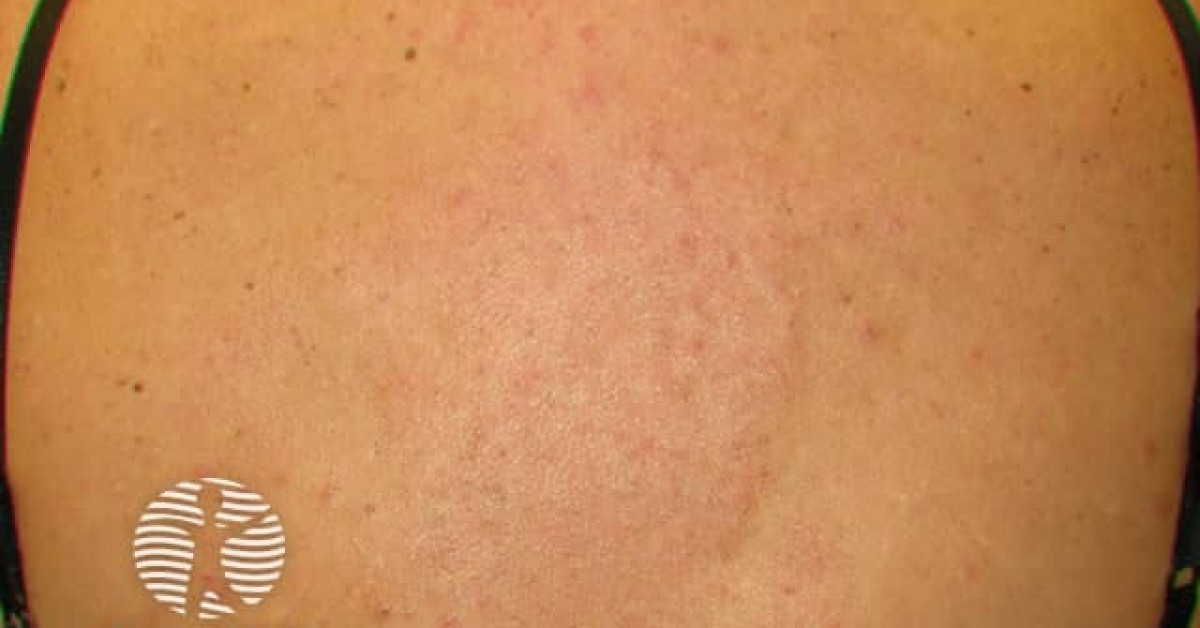 Reticular erythematous mucinosis image