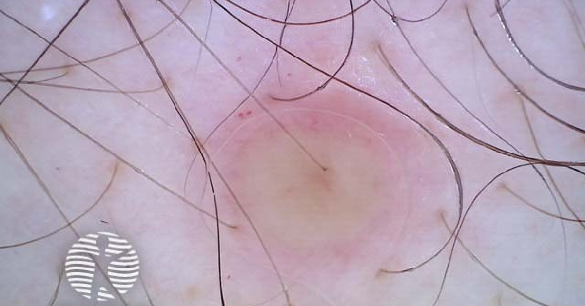 Reticulohistiocytoma dermoscopy image