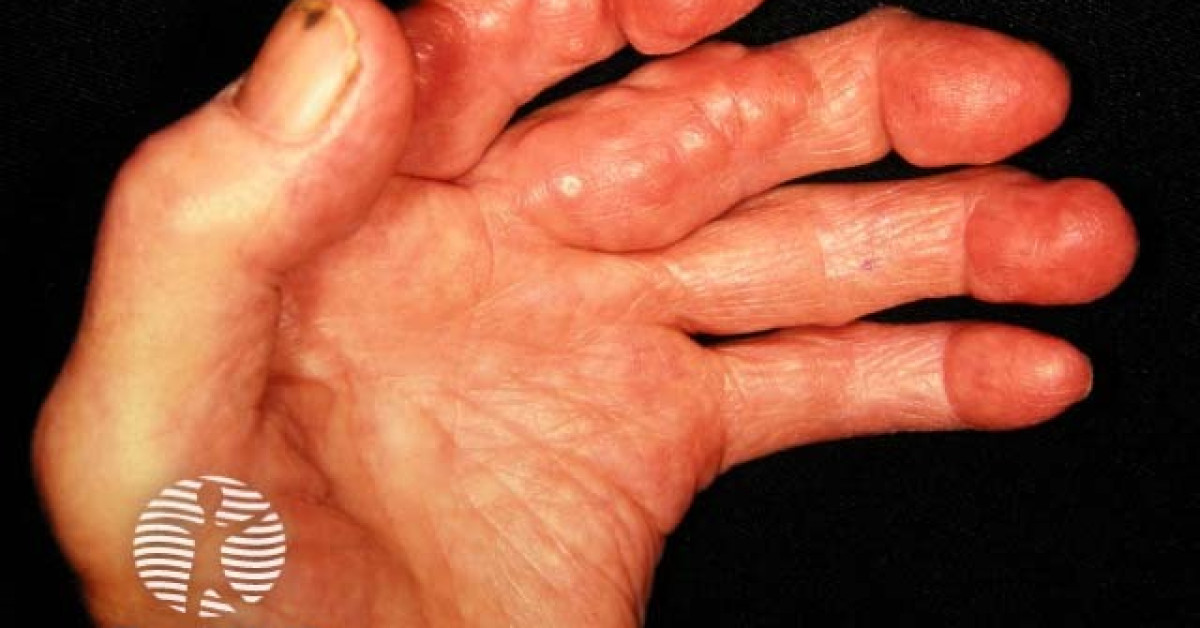 Rheumatoid nodules image