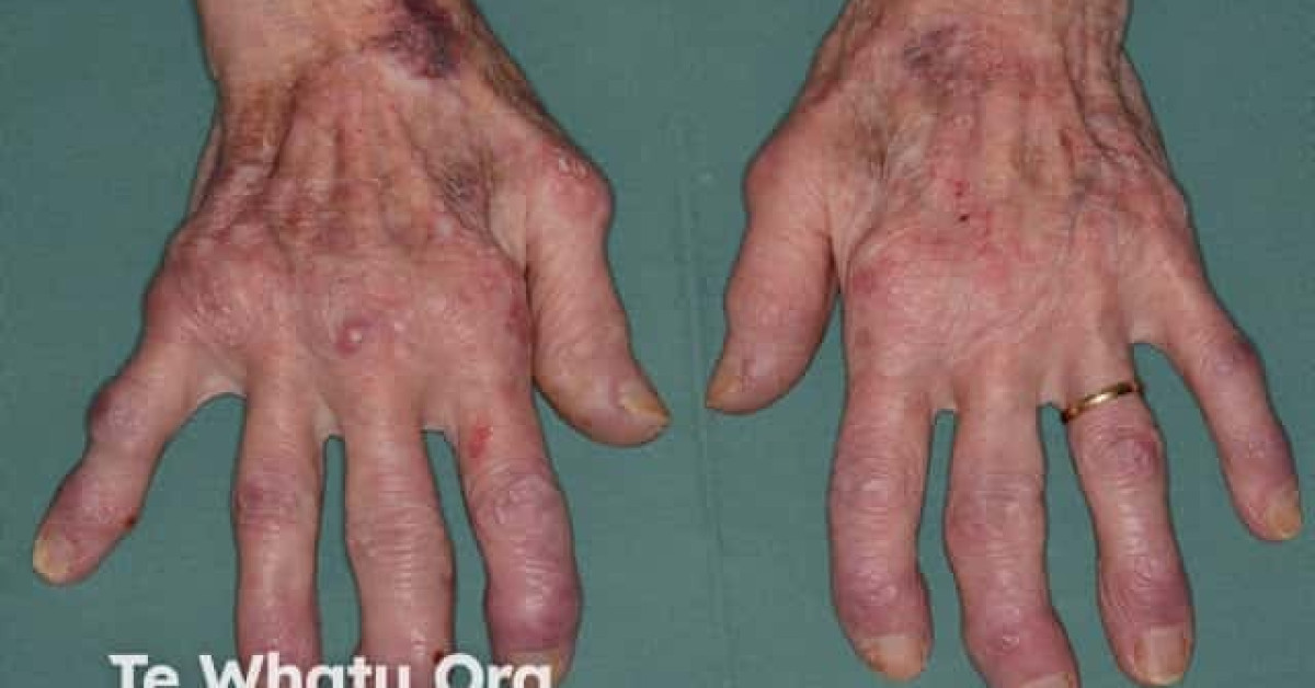 Rheumatoid arthritis of hands image