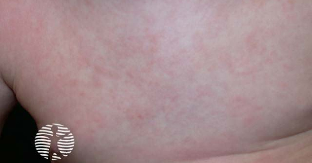 Roseola image
