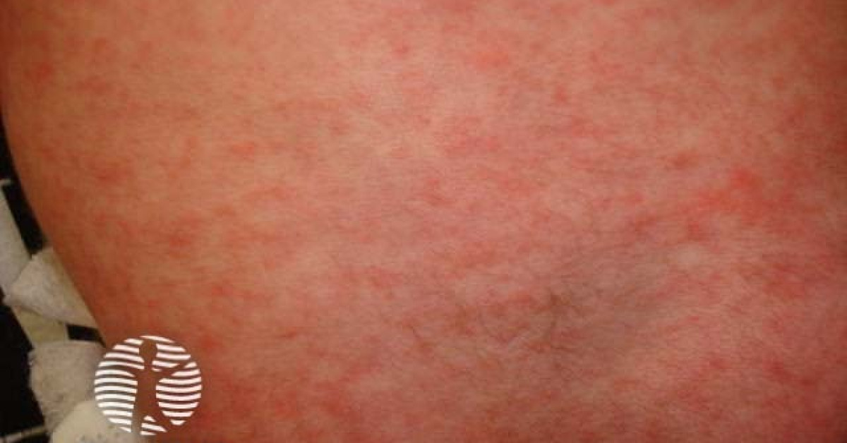 Roseola image