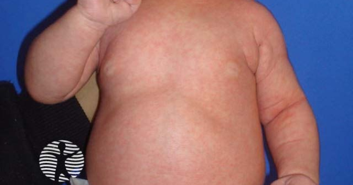 Roseola image