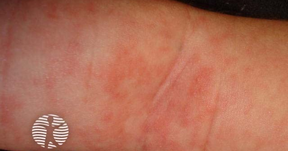 Roseola image