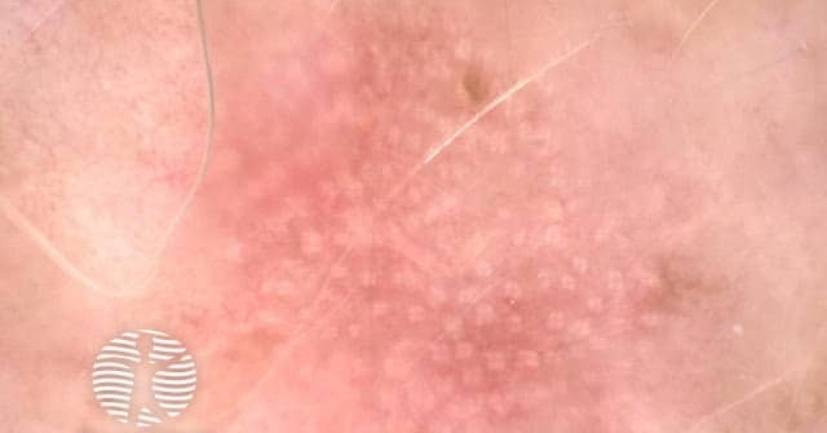 Rosettes in actinic keratosis image
