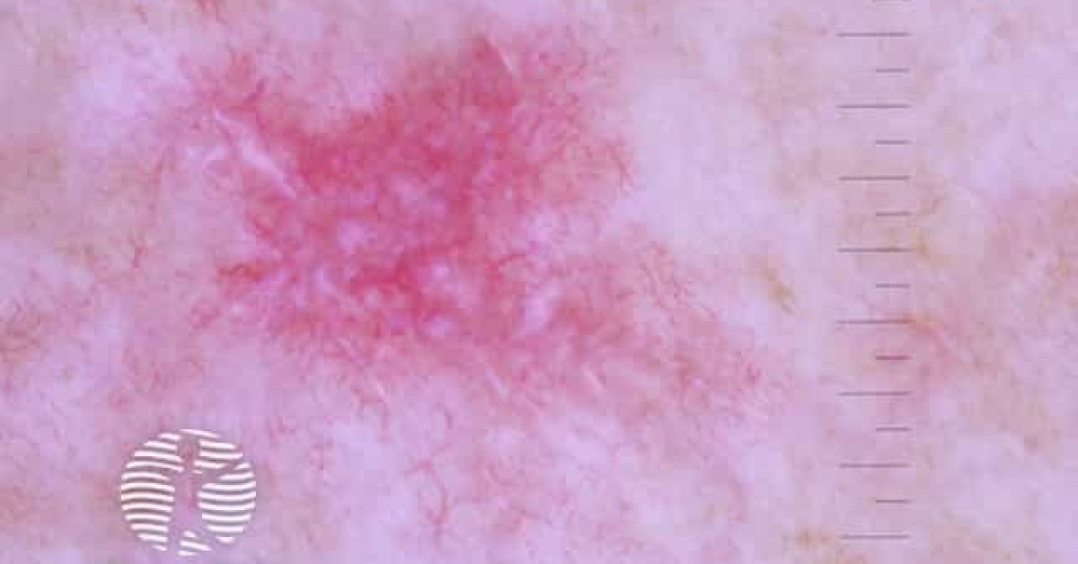 Superficial basal cell carcinoma dermoscopy image