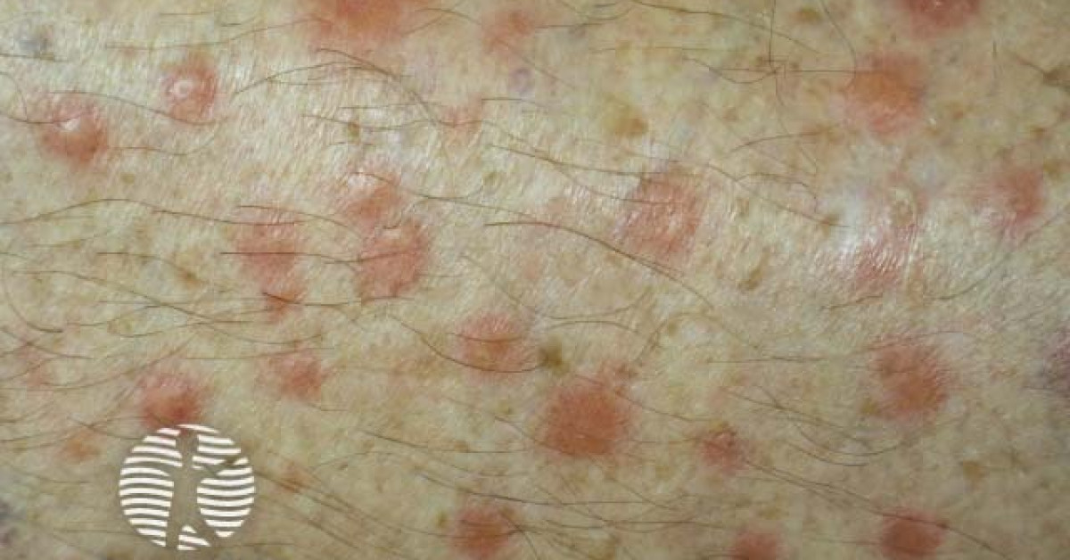 Sarcoid nodules image