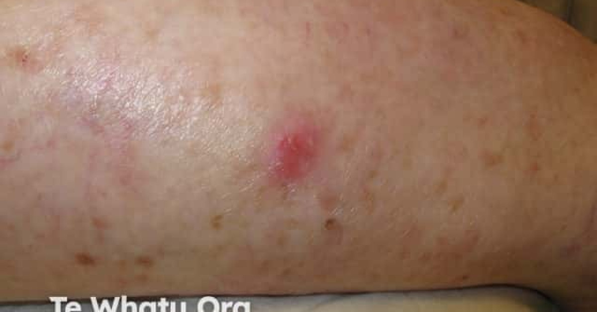 Superficial basal cell carcinoma, arm image