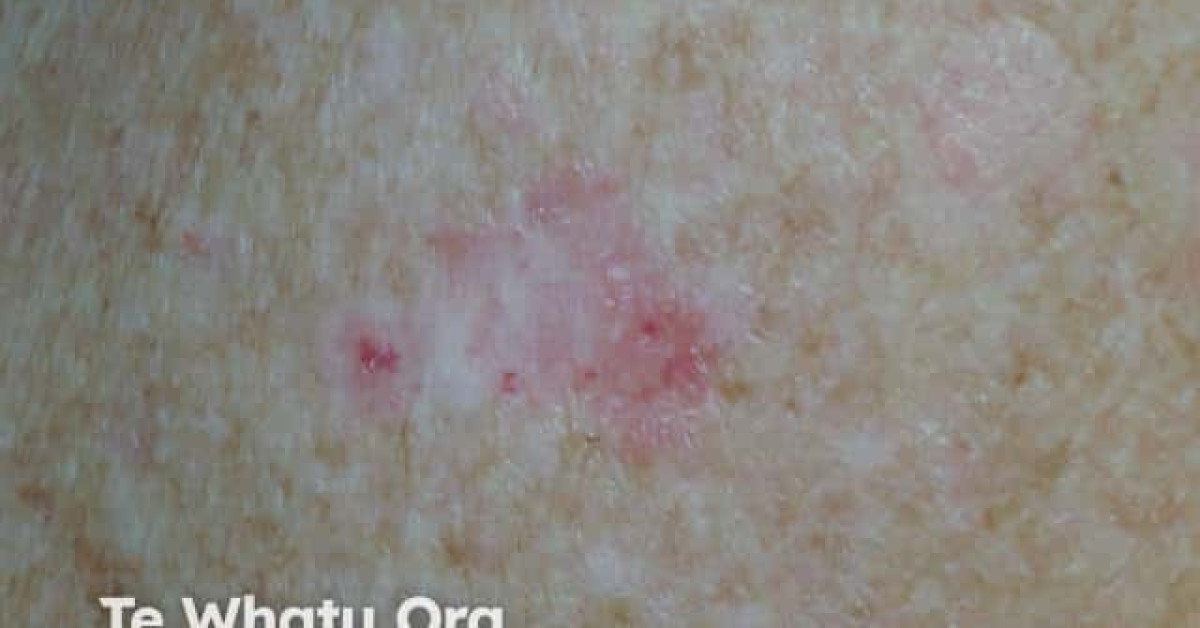 Superficial basal cell carcinoma, arm image