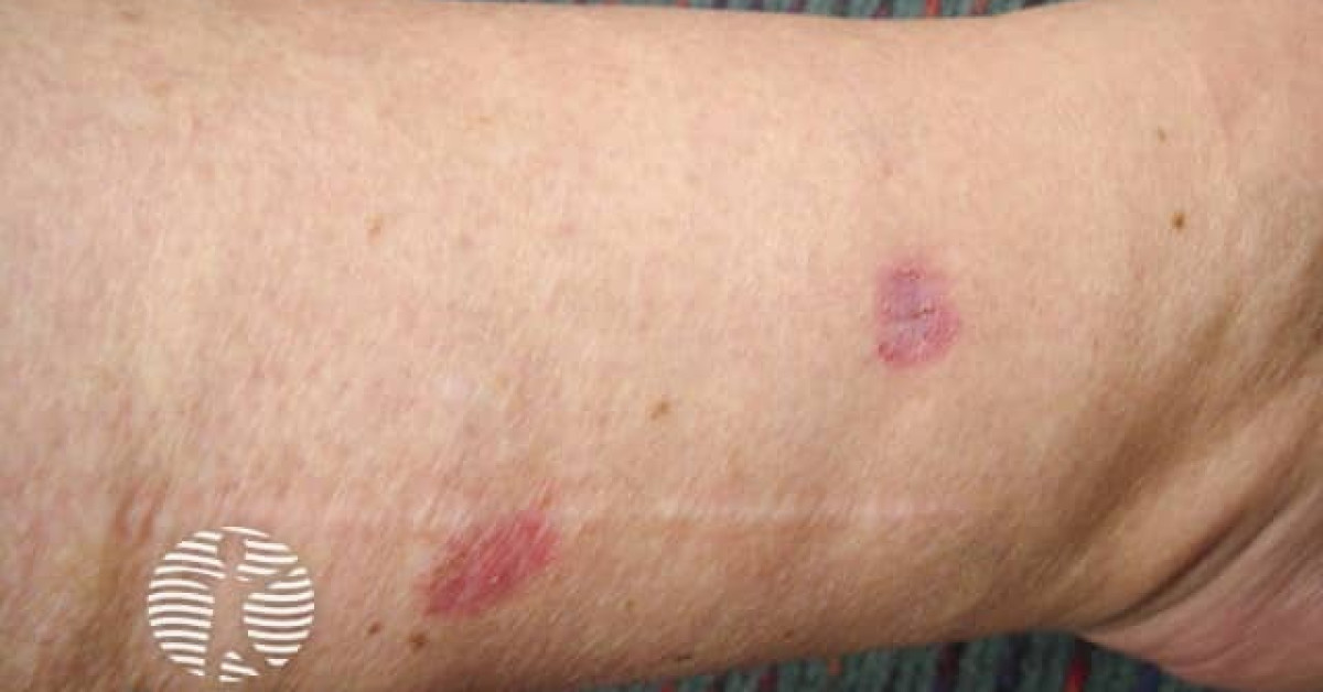 Superficial basal cell carcinoma, leg image