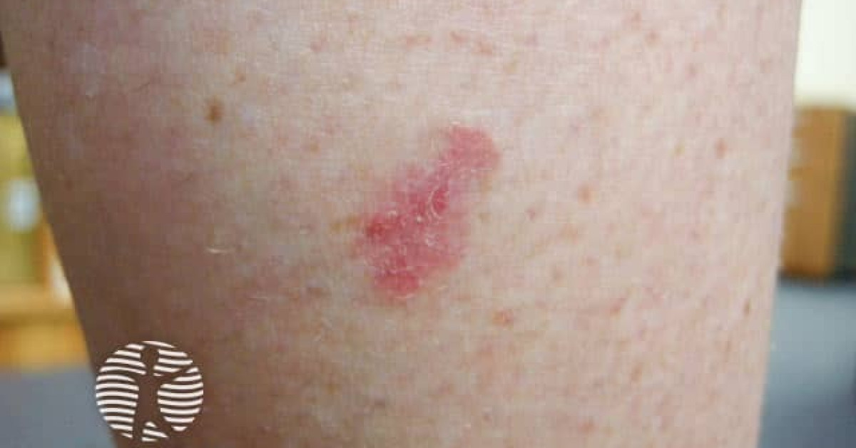 Superficial basal cell carcinoma, leg image