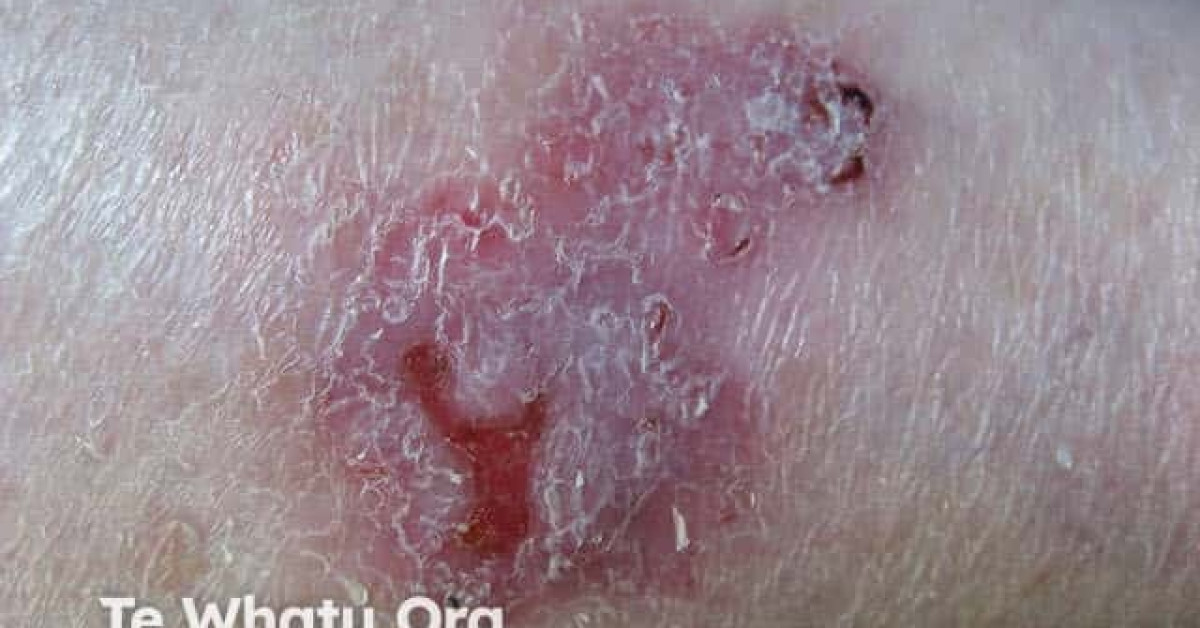 Superficial Basal Cell Carcinoma Leg Image
