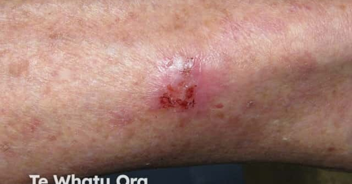 Basal Cell Cancer On Thigh at Mary Bilbo blog