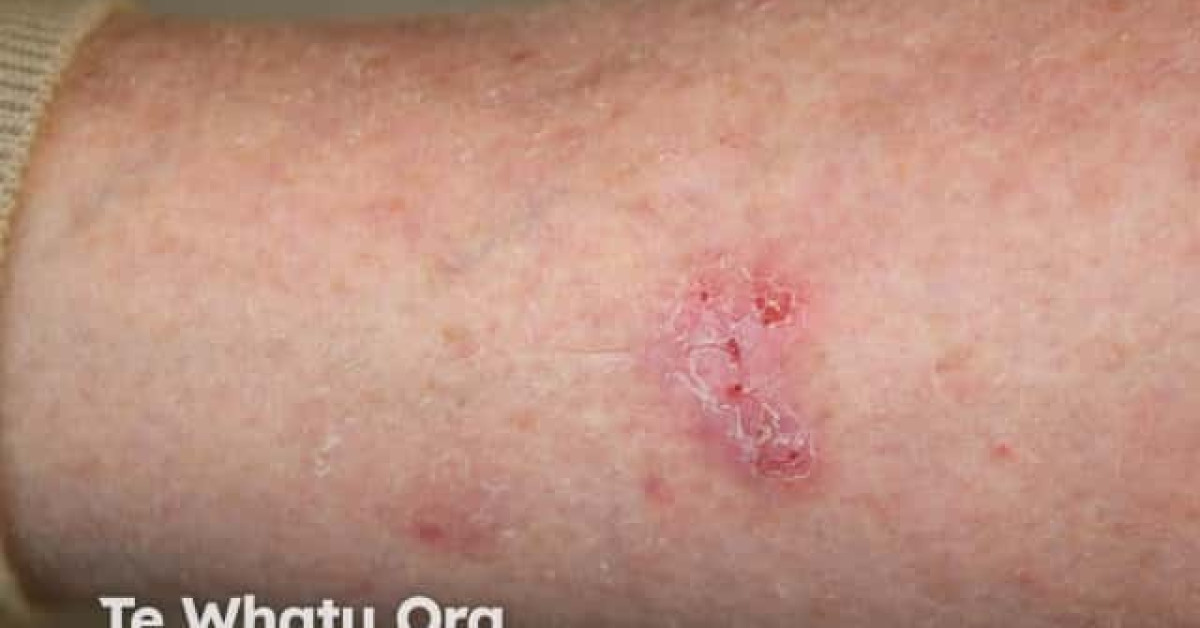 Superficial basal cell carcinoma, leg image