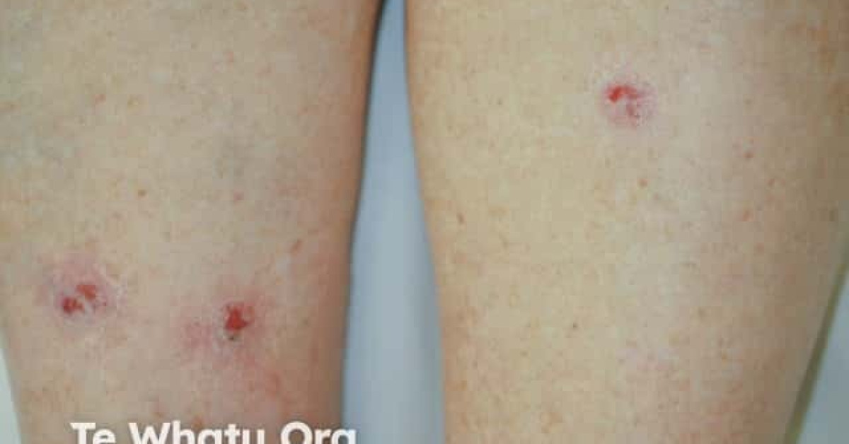 Basal Cell Cancer On Thigh at Mary Bilbo blog