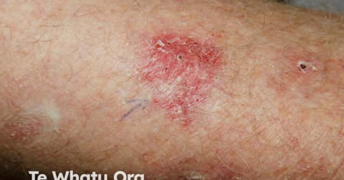 Superficial basal cell carcinoma, leg image