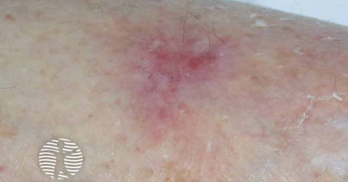 Superficial basal cell carcinoma, leg image