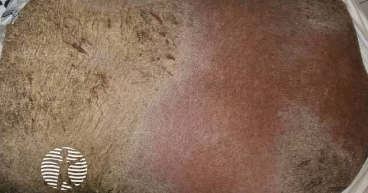 Severe crusted scabies image