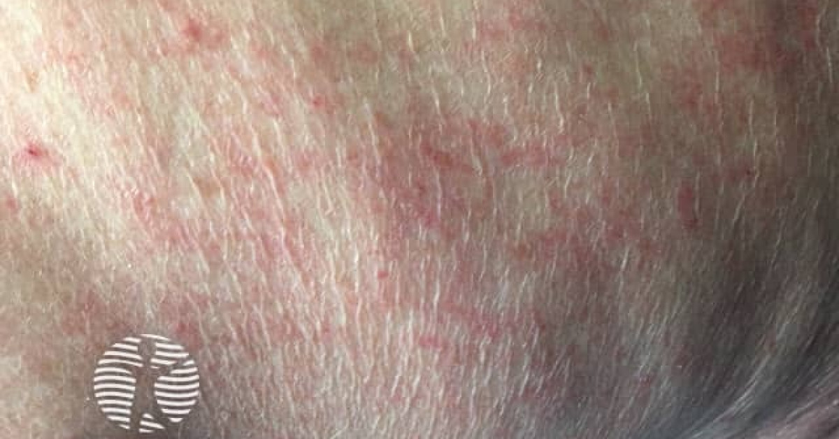 Nonspecific scabies rash image