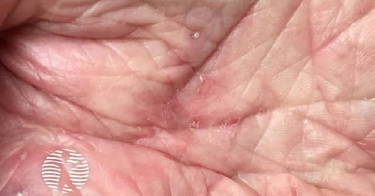 Palmar burrows due to scabies image