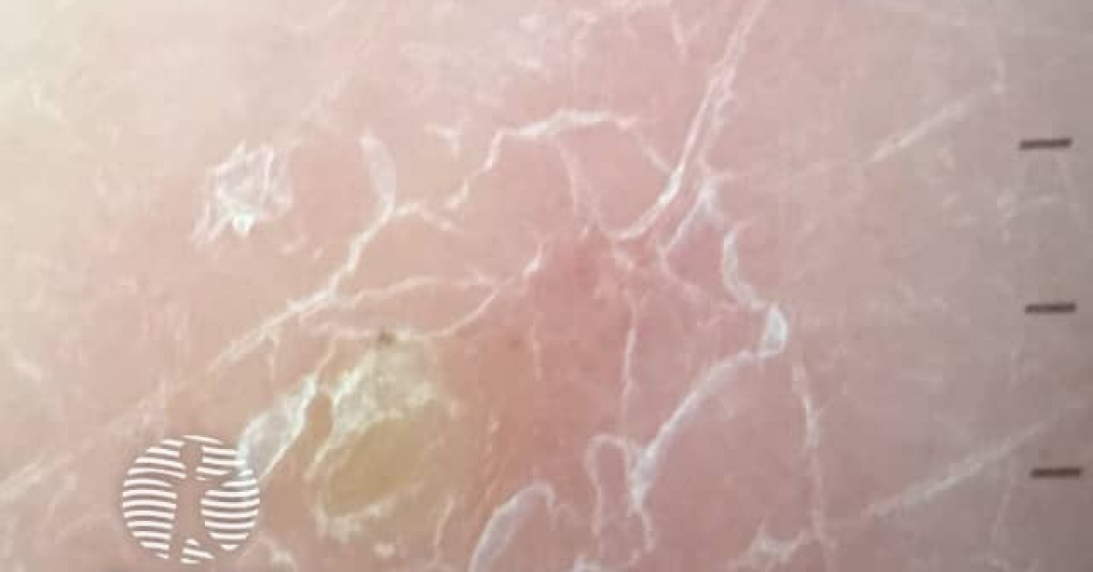 Dermoscopy of scabies burrow image