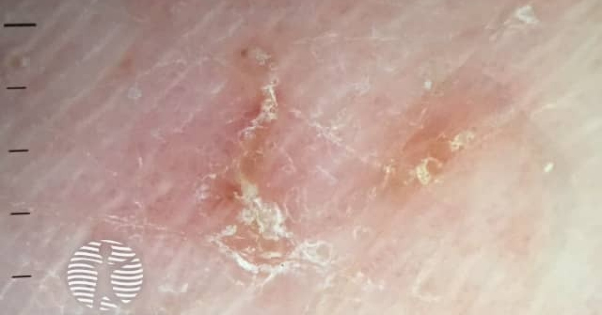 Dermoscopy of scabies burrow image