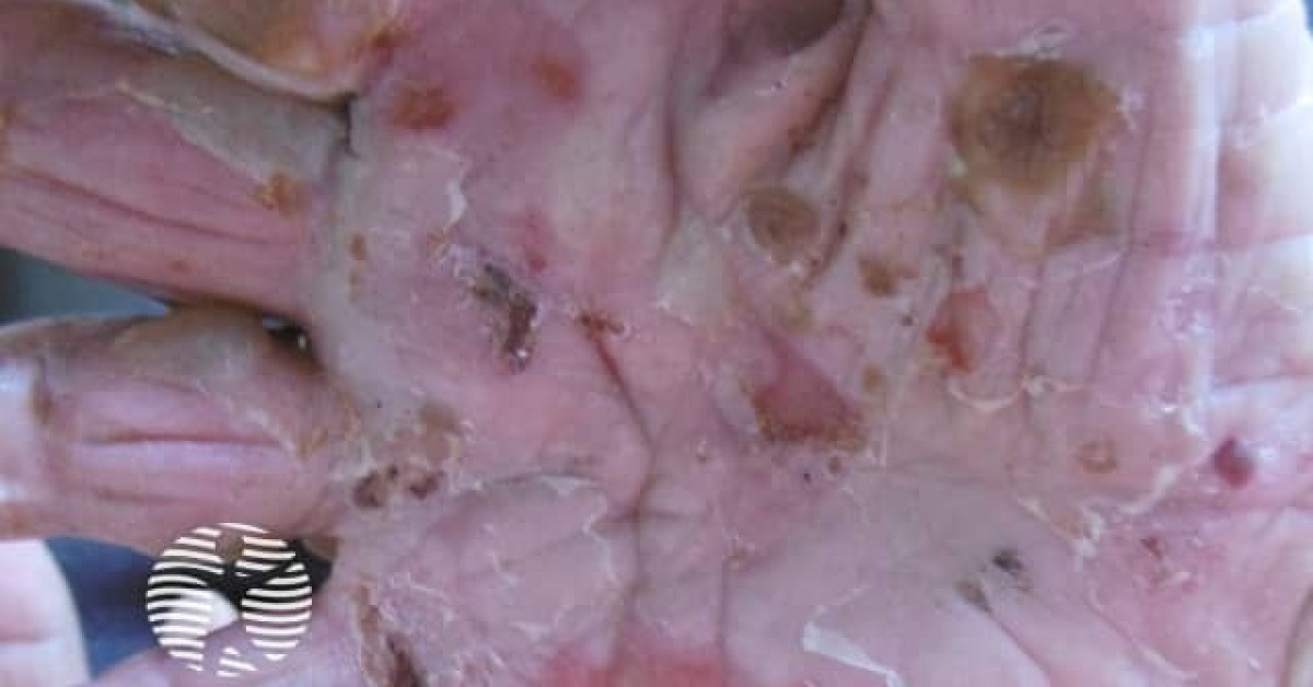 Infected burrows in crusted scabies image