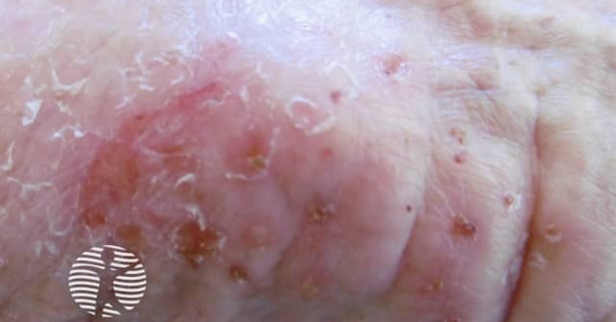 Excoriations in scabies image