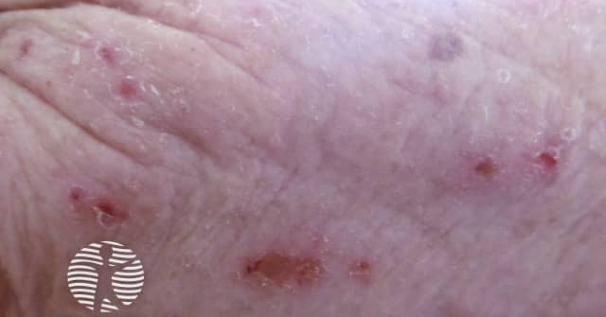 Excoriations in scabies image