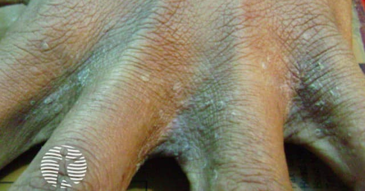 Interdigital burrows due to scabies image