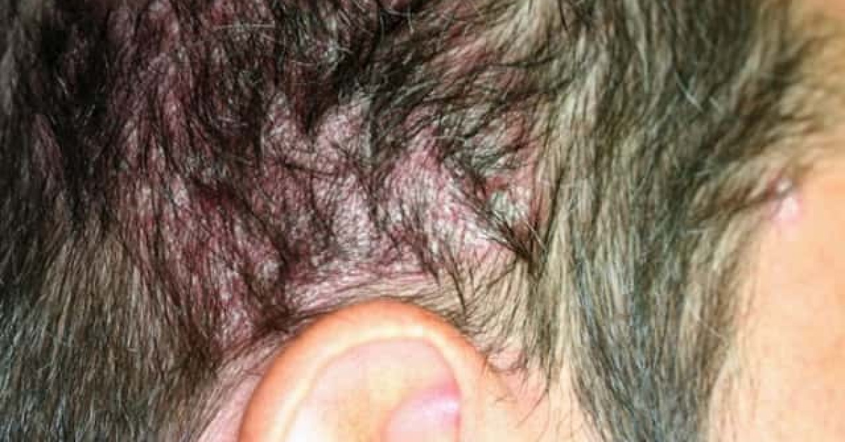 Scalp psoriasis image