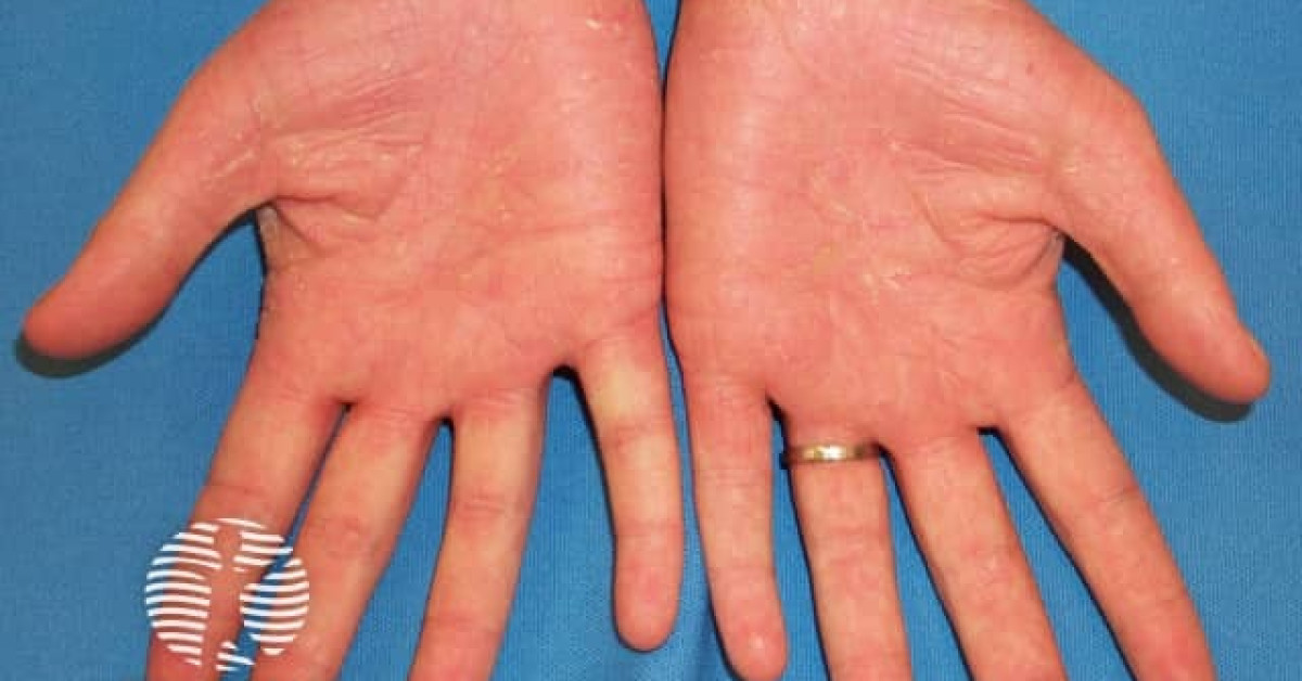 Acquired keratoderma image