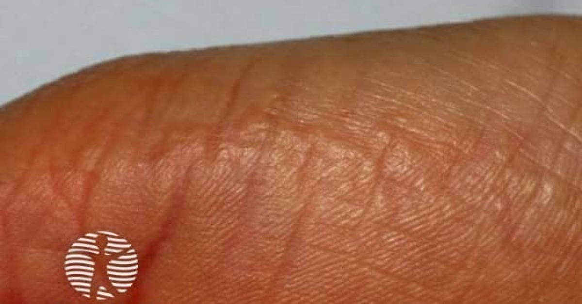 Acrokeratoelastoidosis image