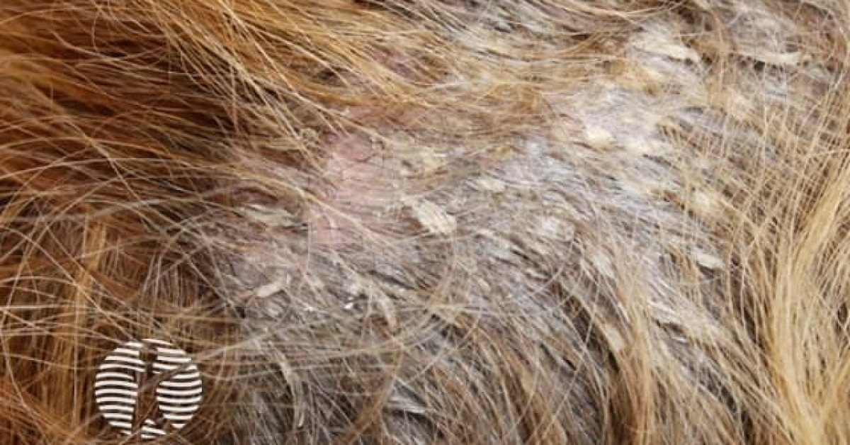 Pityriasis amiantacea image