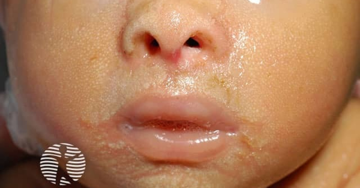 Collodion baby image