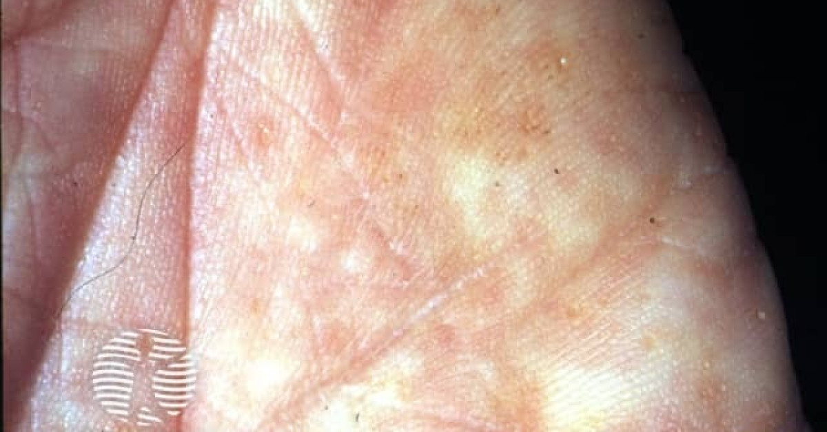 Darier disease image
