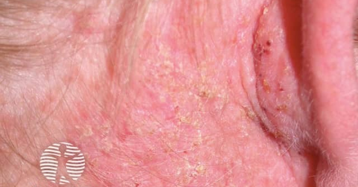 Darier disease image