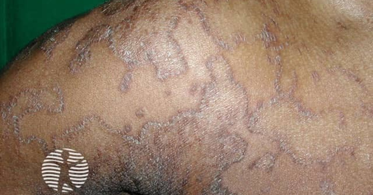 Erythrokeratoderma image