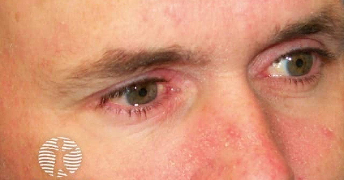 Facial psoriasis image