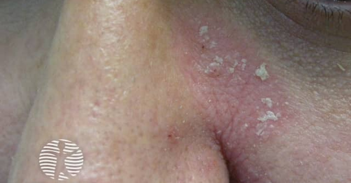 Facial psoriasis image