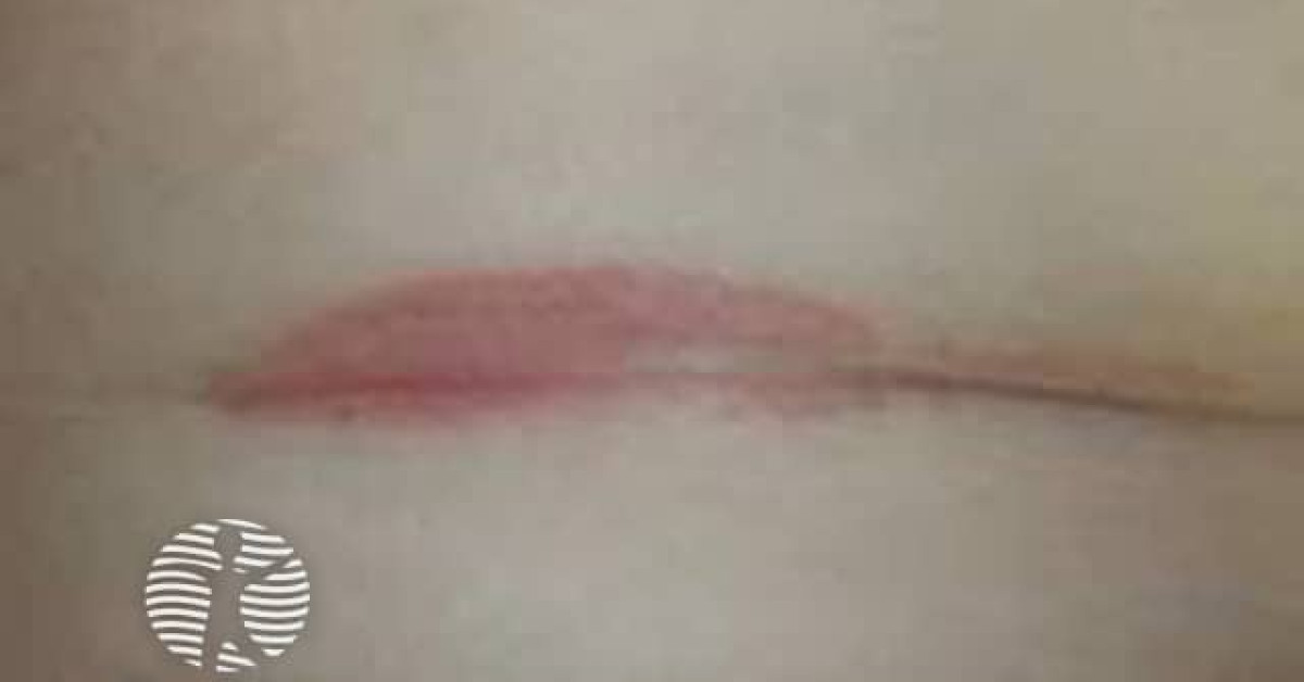 Flexural psoriasis image