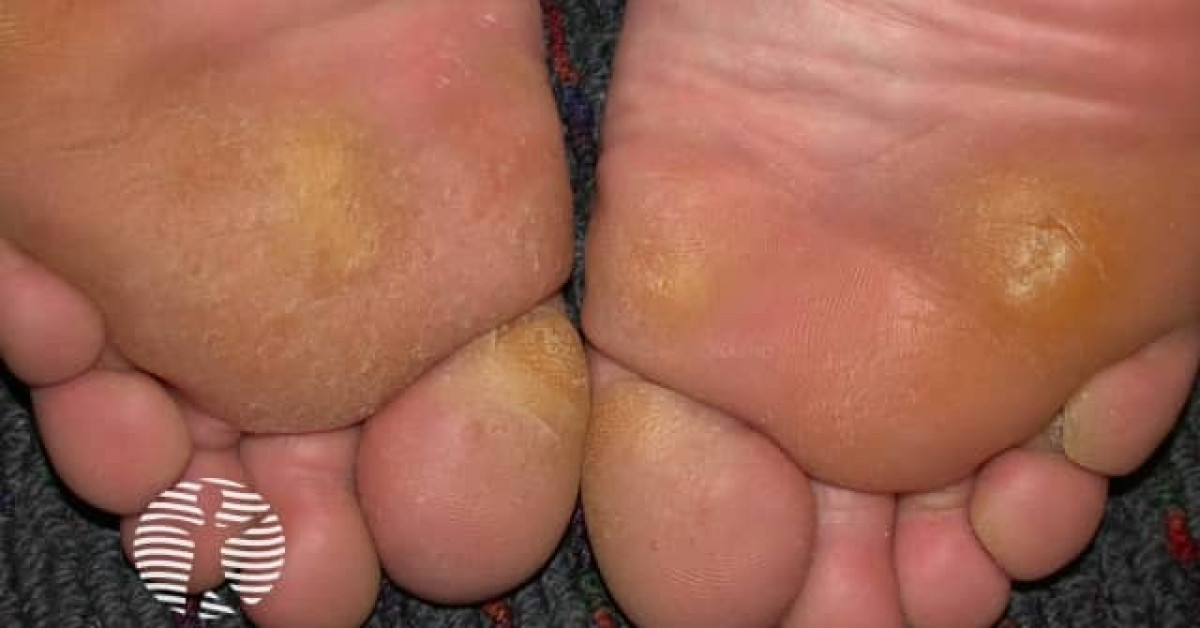 Acquired Plantar Keratoderma Image