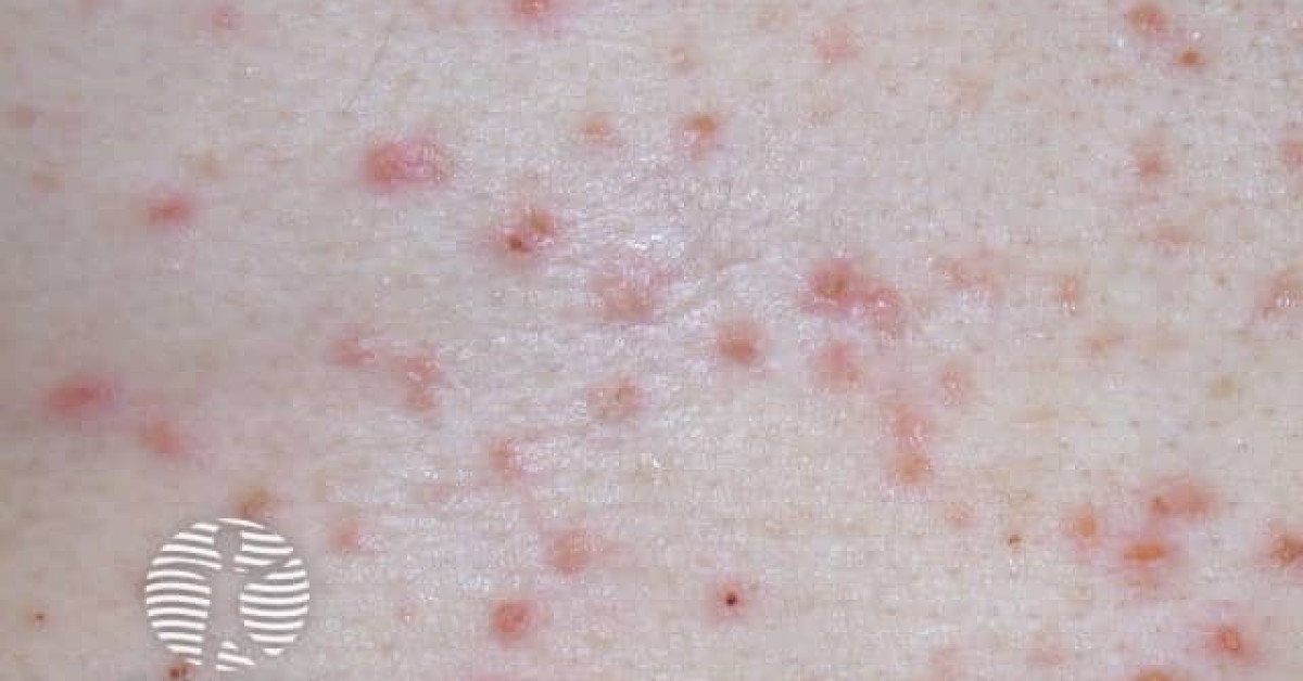 Grovers disease image