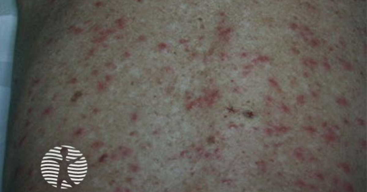 Grover disease image