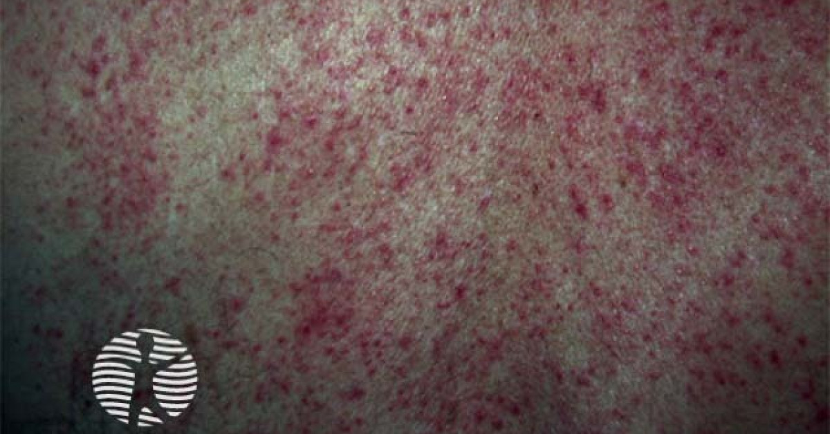 Grover disease image