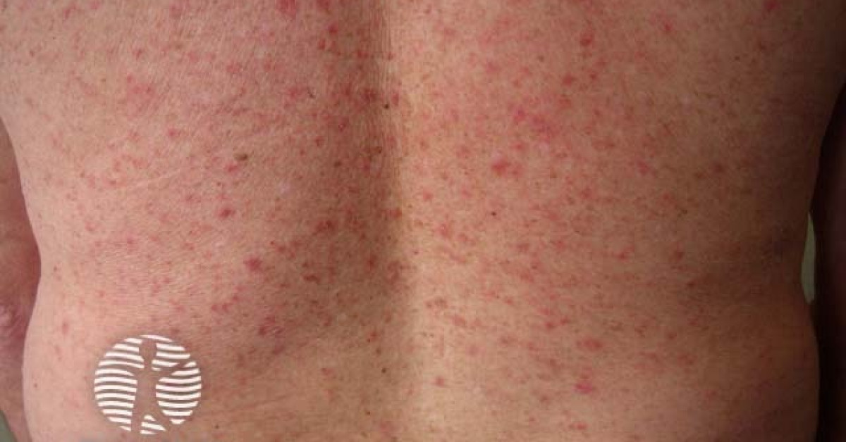 Grover disease image
