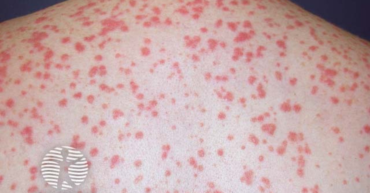 Guttate psoriasis image