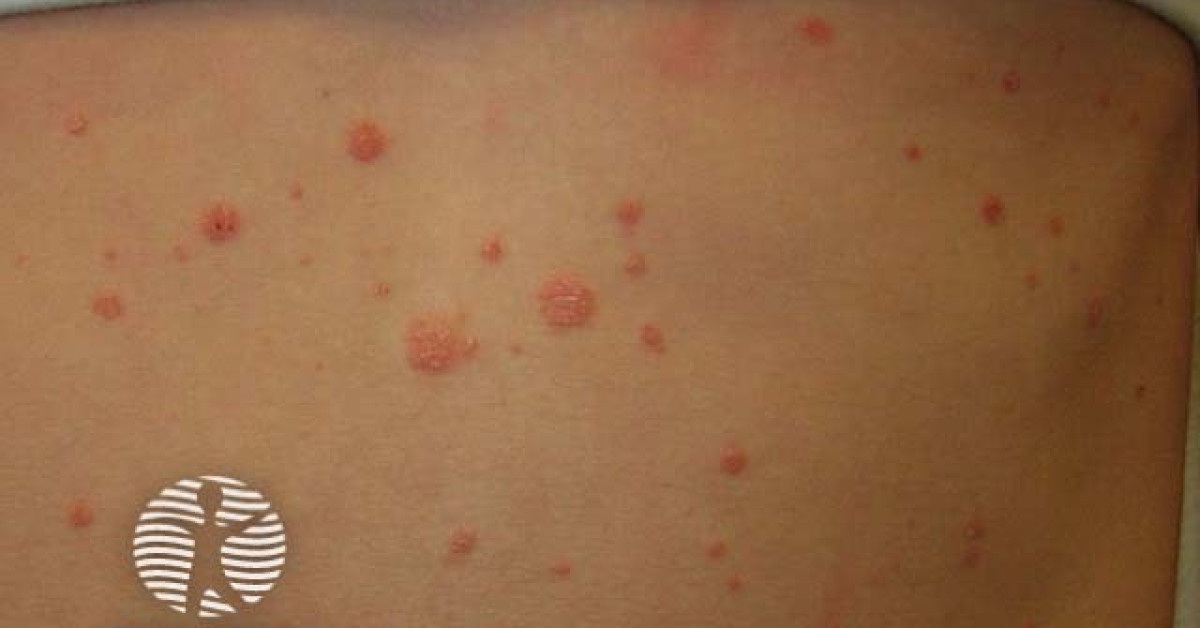 Guttate psoriasis image
