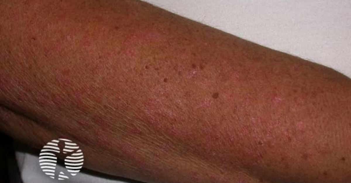 Guttate psoriasis image
